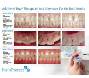 Complete Care Kit - Perio Protect for Providers